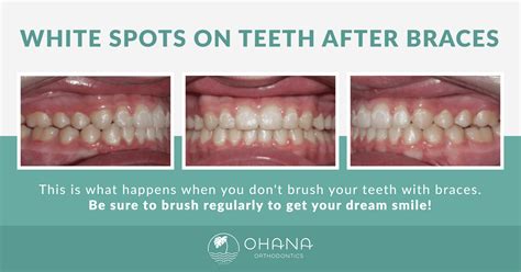 Bad Teeth After Braces