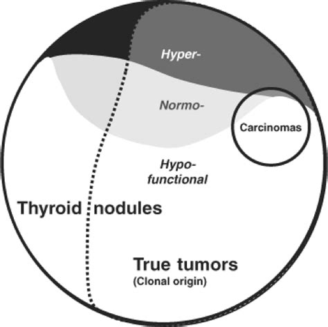 Toxic Adenoma And Toxic Multinodular Goiter Oncohema Key