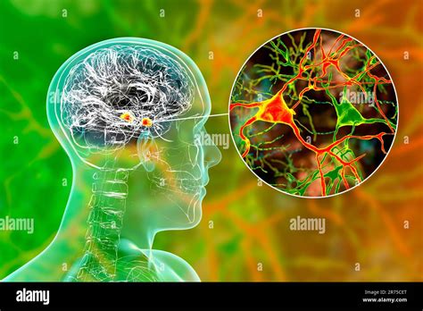 Amygdala In The Brain And Closeup View Of Amygdala Neurons Computer