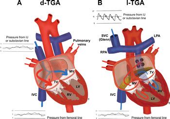 L Transposition Of The Great Arteries