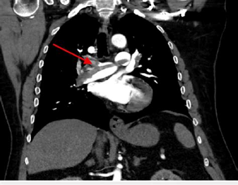Ct Angiogram Showing Saddle Pulmonary Embolus Arrow Download Scientific Diagram