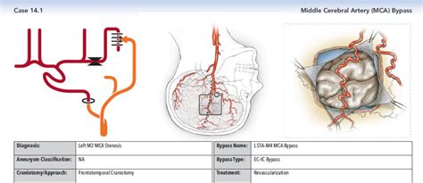 Extracranial Intracranial Bypass Neupsy Key