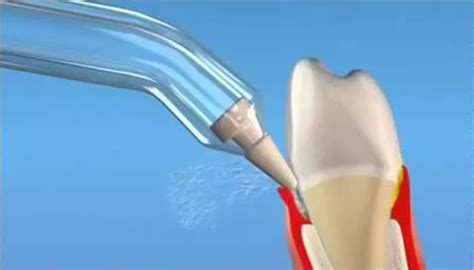 What Is Stage 2 Periodontal Disease