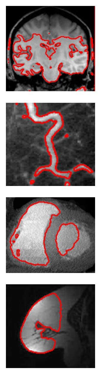 level set segmentation of variant medical images a origional image