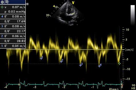 Echocardiography Based Hemodynamic Management In The Cardiac Surgical