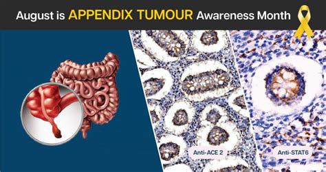 Izak Storm On Linkedin August Is International Appendix Tumor Awareness Month