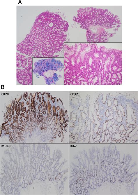 A Serrated Hyperplastic Colonic Polyp Of The Urinary Bladder Urology