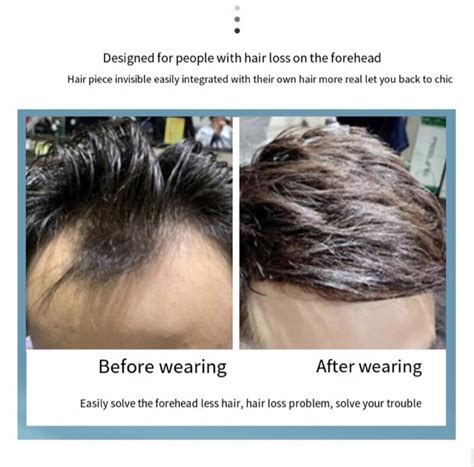 Mens And Womens Hairline Forehead Patch Patch Forehead Fringe