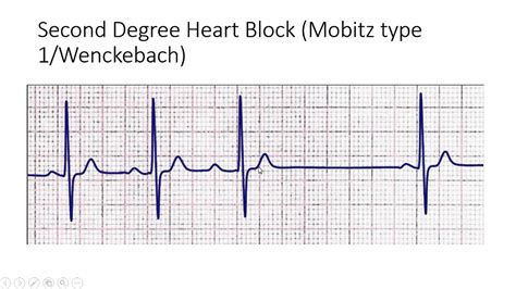 Prepare For Medical Exams Wenckebach Or Type I Second Degree Av Block
