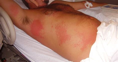 Deatongang Mrsa And Cellulitis
