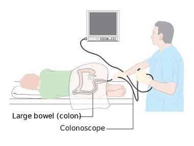 Colonoscopy Procedure