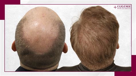Crown Hair Transplant Eugenix Hair Sciences