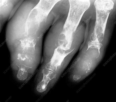 Gout Foot Xray Images At Darcy Trugernanner Blog