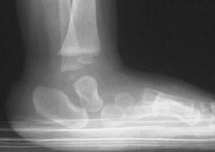 What Does Congenital Vertical Talus Deformity Mean Podiatry Faqs