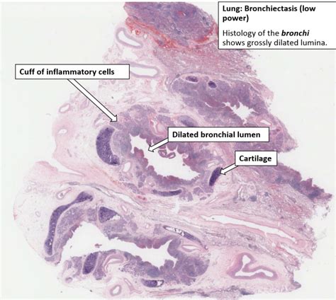 Lung Bronchiectasis Nus Pathweb Nus Pathweb