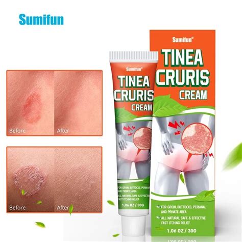 Tinea Cruris Treatment Cream