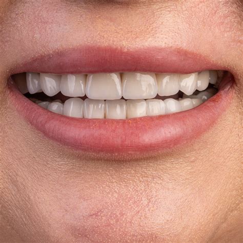 Dens • დენსი 🩵 ცირკონო ფაიფურის გვირგვინებით ღიმილის აღდგენა ექიმი ორთოპედი პაპუნა ლოსაბერიძე