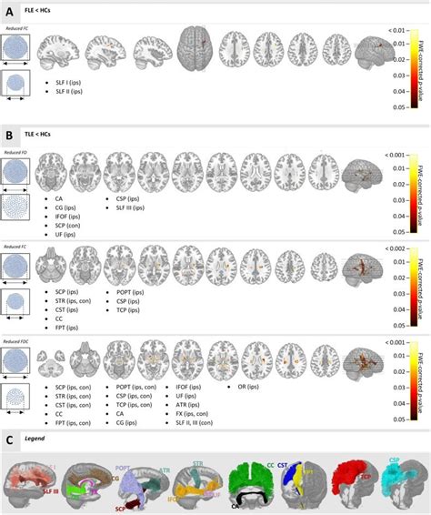 White Matter Alterations In Mr Negative Temporal And Frontal Lobe Epilepsy Using Fixel Based