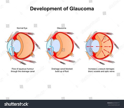 Development Glaucoma Diagram Eye Stock Vector 667630171 Shutterstock