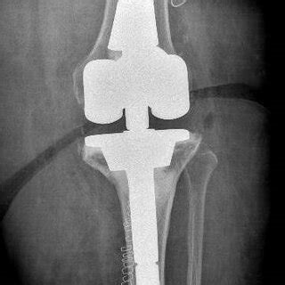 A B Types Of Stems And Cones Utilized In Revision Tka Download