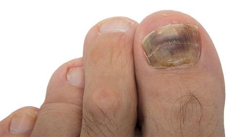 Skin Cancer Symptoms Dark Vertical Band On Nails Could Signal You Have