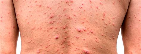 Hiv Rash Pictures Symptoms Causes Treatment