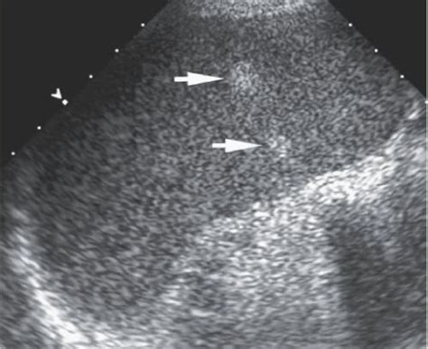 Chapter 6 Spleen Flashcards Quizlet