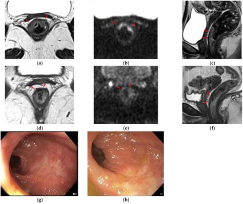 Mri Evaluation Of Complete And Near Complete Response After Neoadjuvant