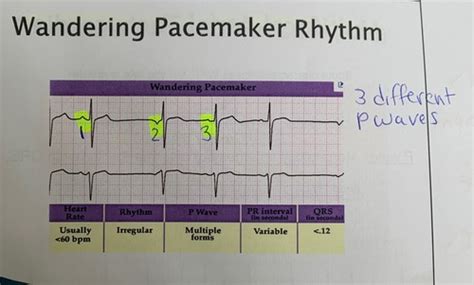 Basic Arrhythmia Class Flashcards Quizlet