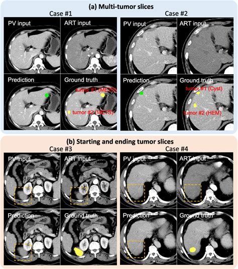 figure 10 from multi modal tumor segmentation with deformable