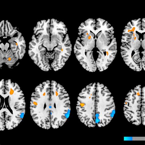 Whole Brain Analysis T Maps Of Brain Activation During Divergent Download Scientific Diagram