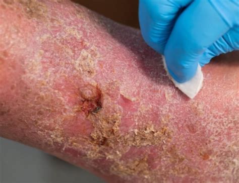 HAP Final Only Flashcards Quizlet