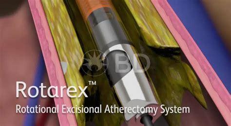 Rotarex™ Rotational Excisional Atherectomy System Elevate Your Atherectomy Expectations With