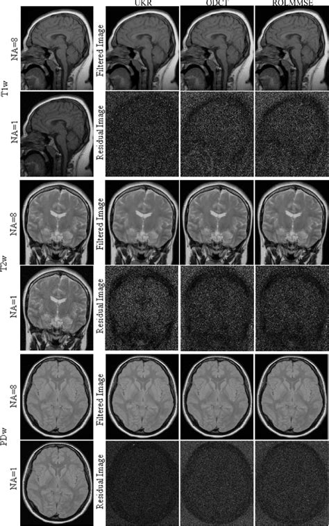 Denoising Results Of Different Methods Applied To Real Brain Mr Data