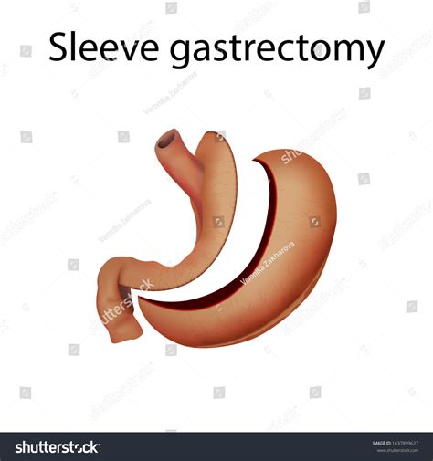 Sleeve Gastrectomy Stomach Surgery Medical Anatomy Stock Illustration