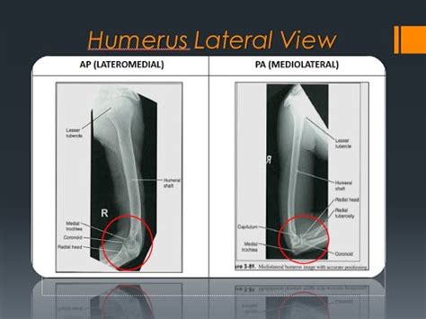 Humerus Aplateral Radiograph Image How To Critique Paceman Method