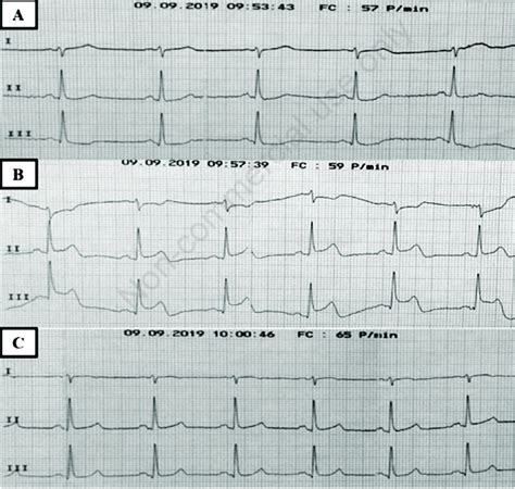 Ecg Before A And After B Sublingual Nitroglycerin Administration