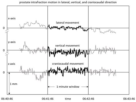 Planning Ct Identifies Patients At Risk Of High Prostate Intrafraction Motion
