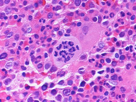 Megakaryocytes In Bone Marrow