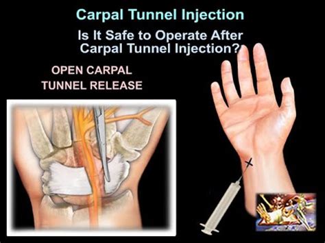 Carpal Tunnel Syndrome Injection