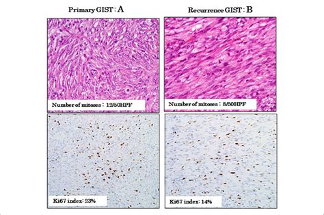Histology Indicated That The Primary Tumor Was Composed Of Spindle Download Scientific Diagram