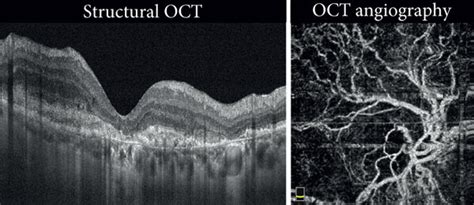 Fibrotic Cnv Structural Oct Shows The Presence Of Minimal Exudation
