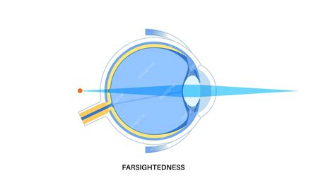 Premium Vector Farsightedness Eye Disease