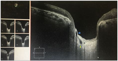 high definition oct images through the optic nerve head using the