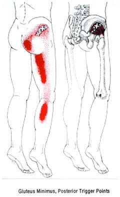 Gluteus Minimus Trigger Point