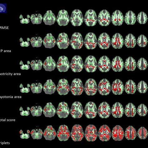 Tract Based Spatial Statistics Tbss Correlations Results Displayed