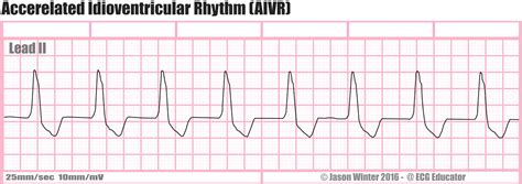 Ecg Educator Blog Ventricular Rhythms