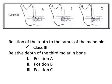 Third Molar Impaction Basic Pptx Third Molar Impaction Basic Pptx
