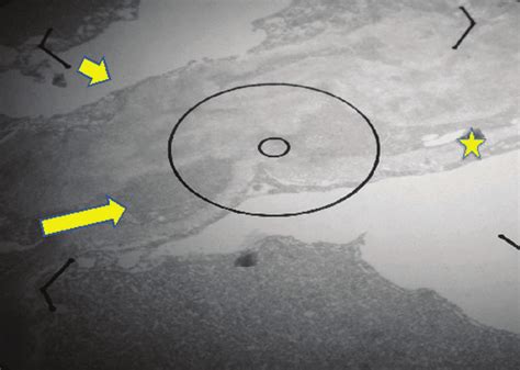 Electron Microscopy Findings Of Renal Biopsy Diffuse Foot Process Download Scientific Diagram