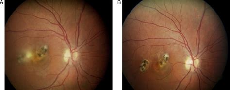 Retinocoroiditis Toxoplásmica ¿recidiva O Membrana Neovascular